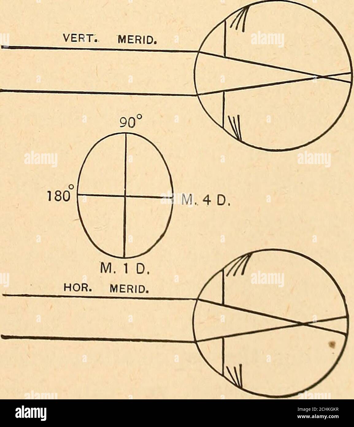 Mixed astigmatism hi-res stock photography and images - Alamy
