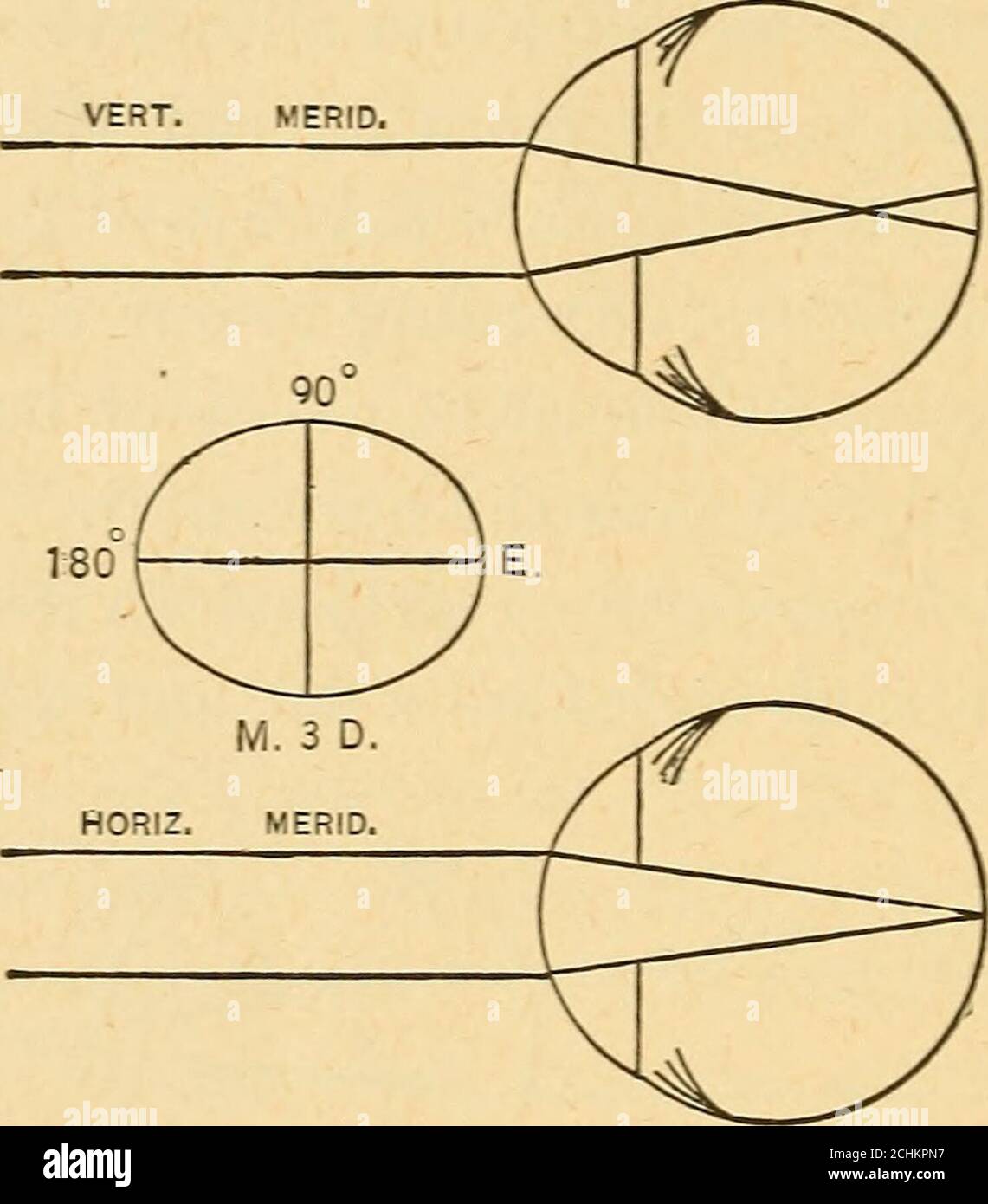 Compound myopic astigmatism hi-res stock photography and images - Alamy