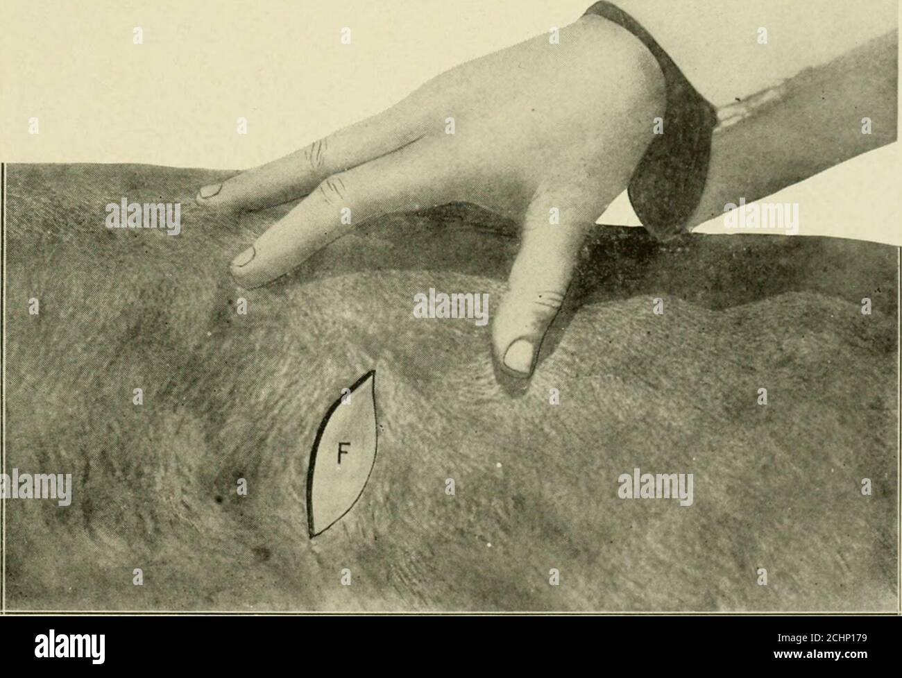 Abdominal thrust hi-res stock photography and images - Alamy