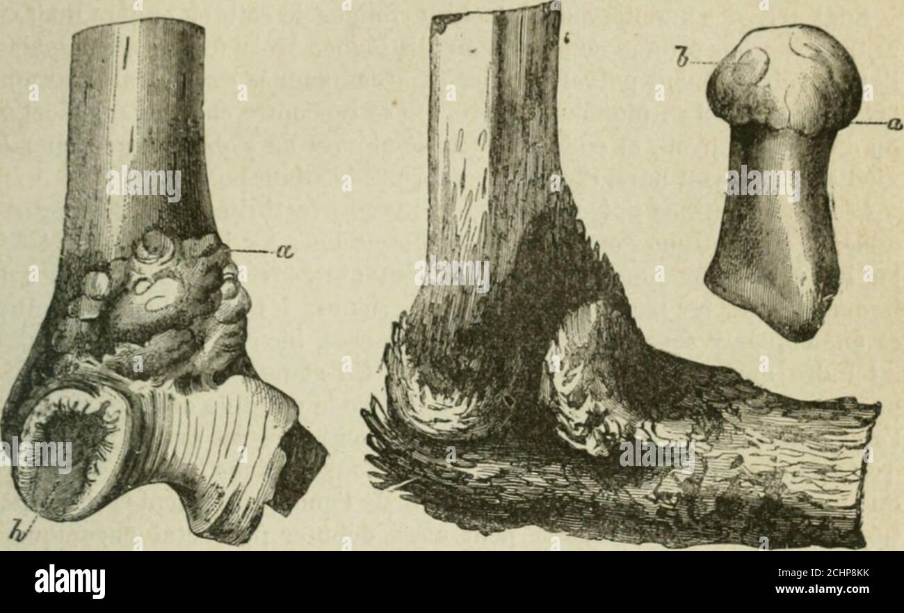 Pathologie osseuse hi-res stock photography and images - Alamy