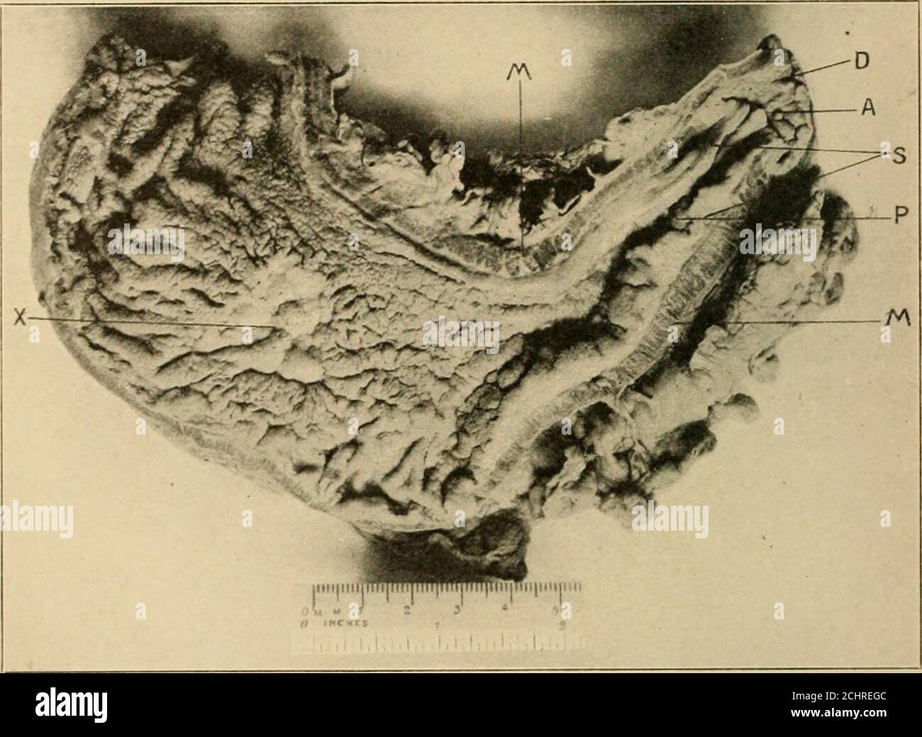 Scirrhous hi-res stock photography and images - Alamy