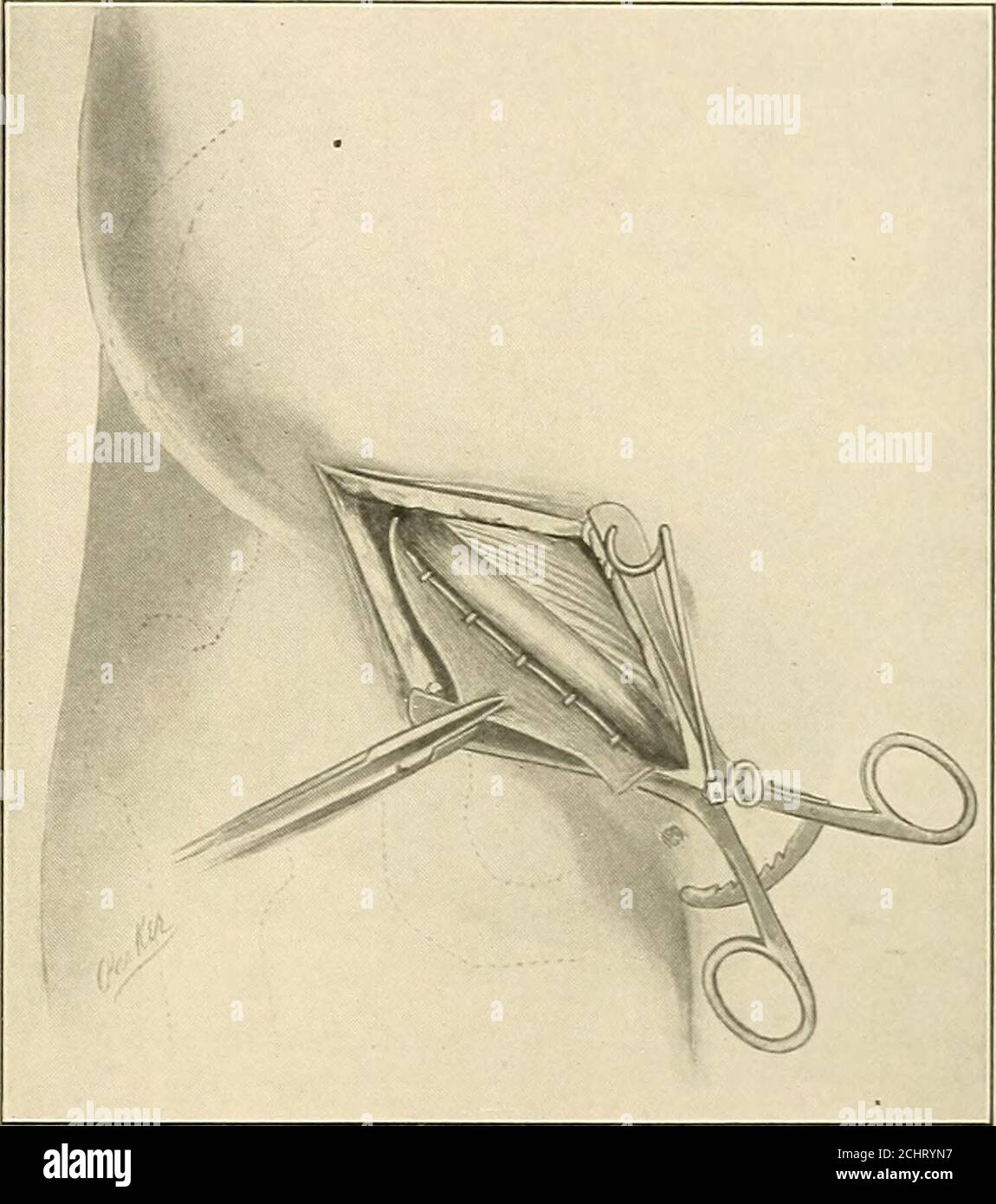 Saphenous opening hi-res stock photography and images - Alamy