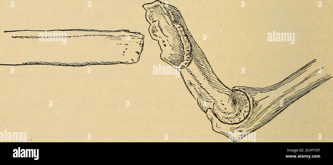 . Atlas and epitome of traumatic . Fig. 10.—False joint after fracture ...