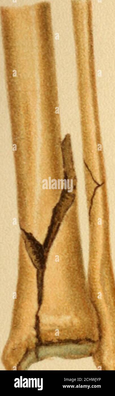 . Atlas and epitome of traumatic . Fig. 4-a Fig. 4b Lith FRACTURES OF ...