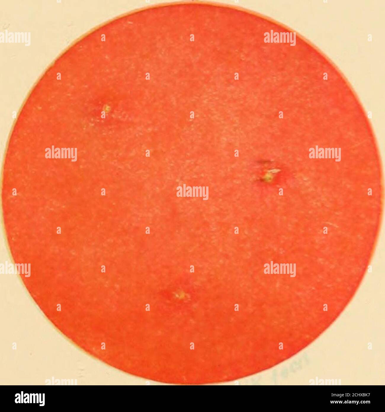 . The diseases of infancy and childhood . The Pathognomonic Sign of ...