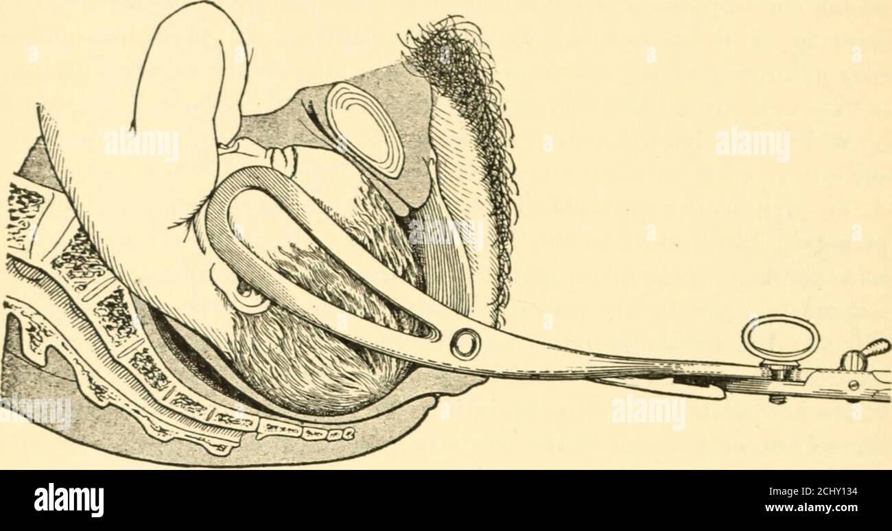 Occipito posterior hi-res stock photography and images - Alamy