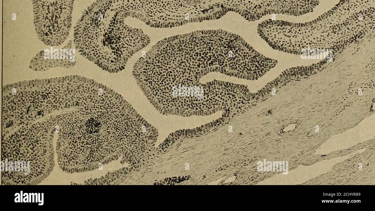 Acute salpingitis hi-res stock photography and images - Alamy