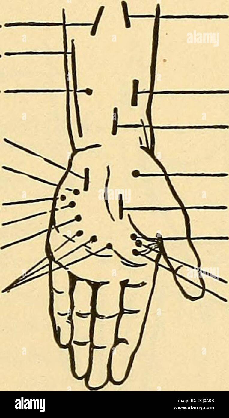 Extensor apparatus hi-res stock photography and images - Alamy