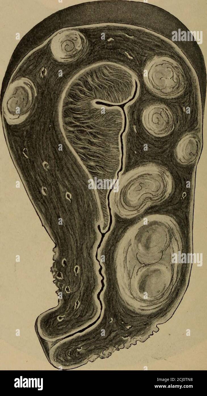 . The diagnosis of diseases of women . Subperitoneal fibroid of the ...