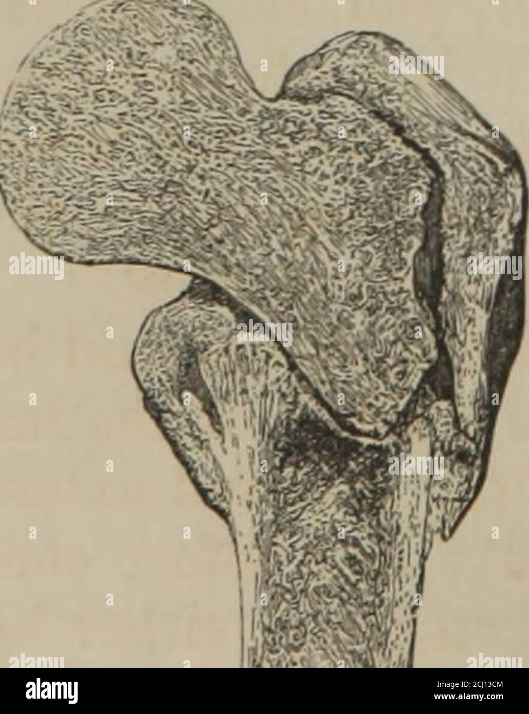 Impacted bone fracture hi-res stock photography and images - Alamy