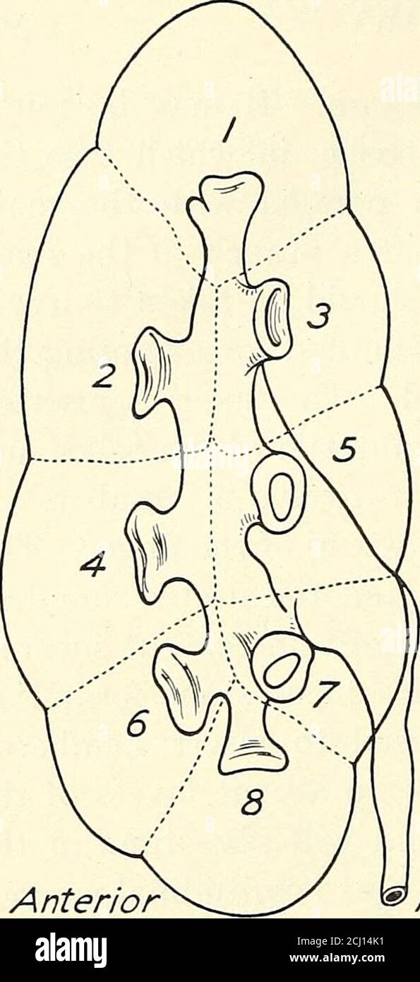 Nephrolithotomy hi-res stock photography and images - Alamy