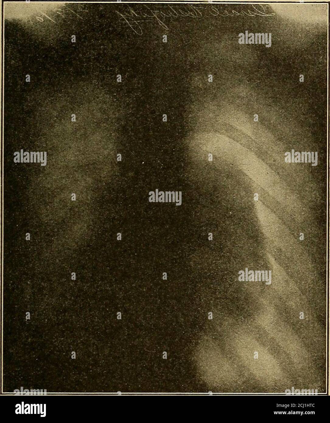 Pneumothorax radiograph hi-res stock photography and images - Alamy