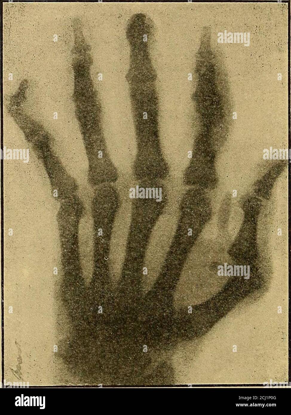 . Physical diagnosis . Fig. 232.—Gouty Tophus in theEar. Fig. 233 ...