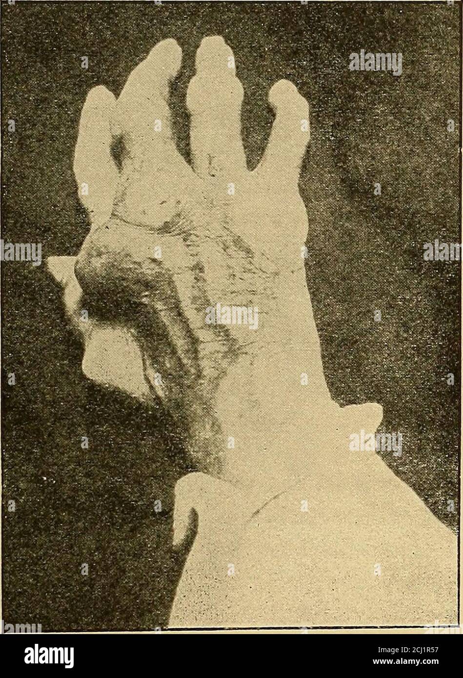 . Physical diagnosis . Fig. 232.—Gouty Tophus in theEar. Fig. 233 ...