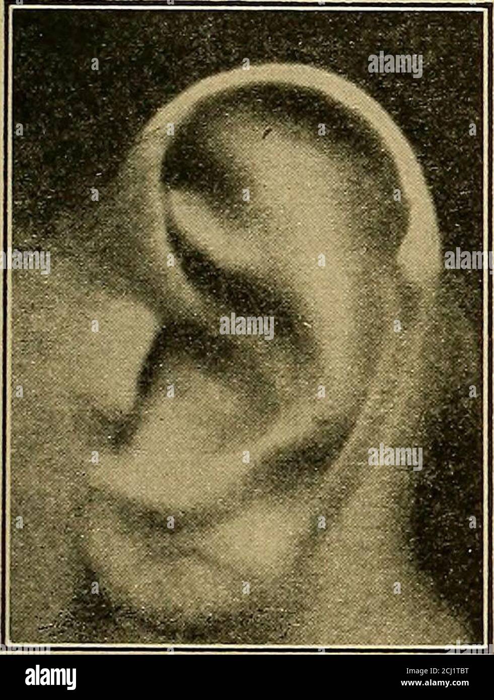 . Physical diagnosis . Fig, 231.—Hypertrophic Arthritis of Spine ...