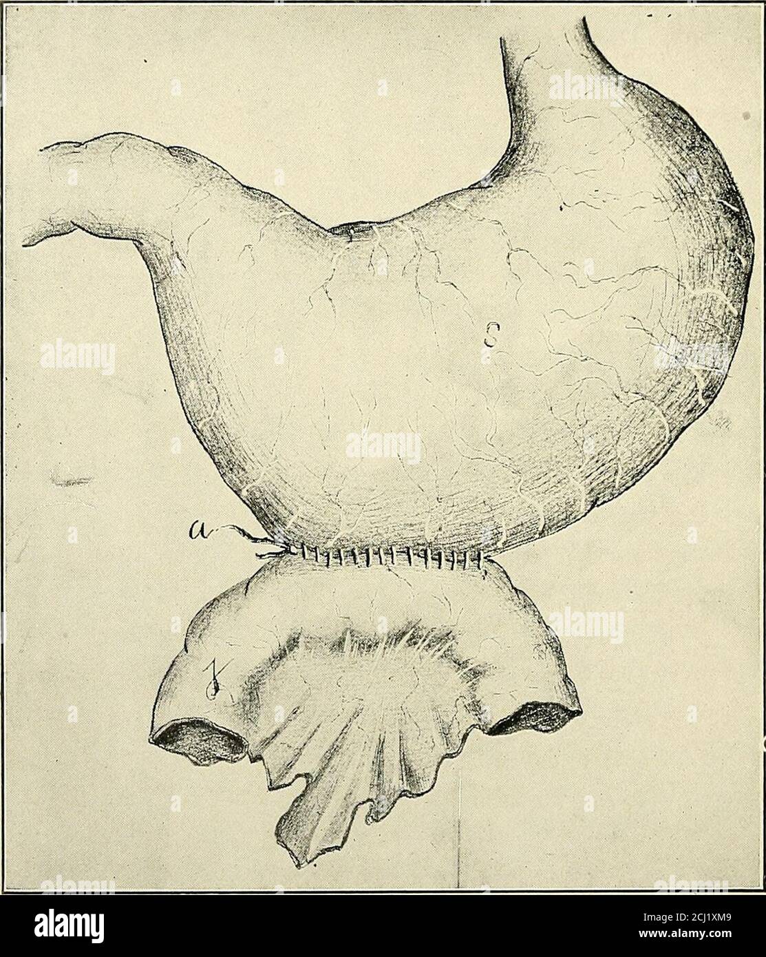Gastric hemorrhage hi-res stock photography and images - Alamy