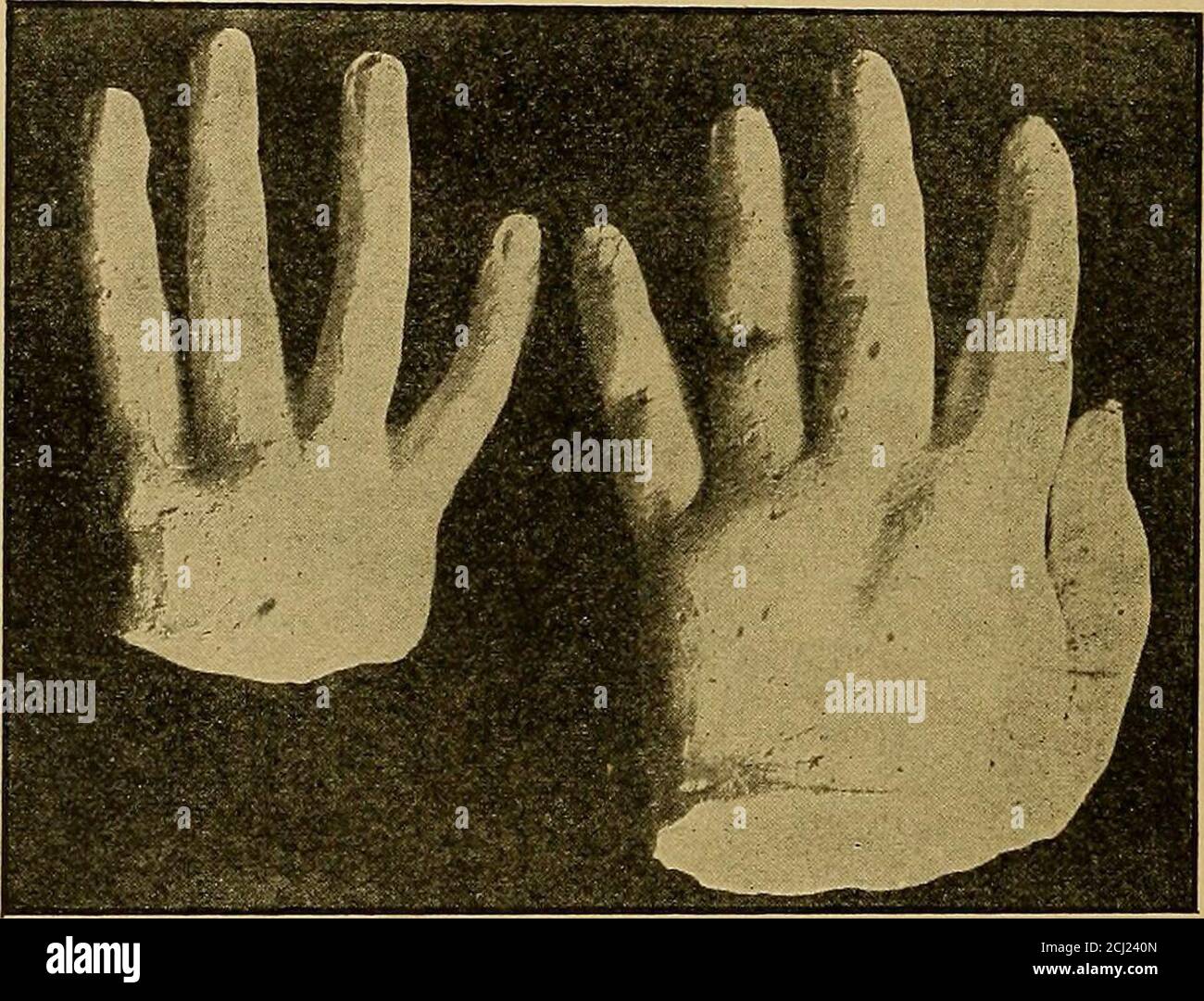 . Physical diagnosis . Fig. 225.--Atrophic Arthritis. (Goldthwaite ...