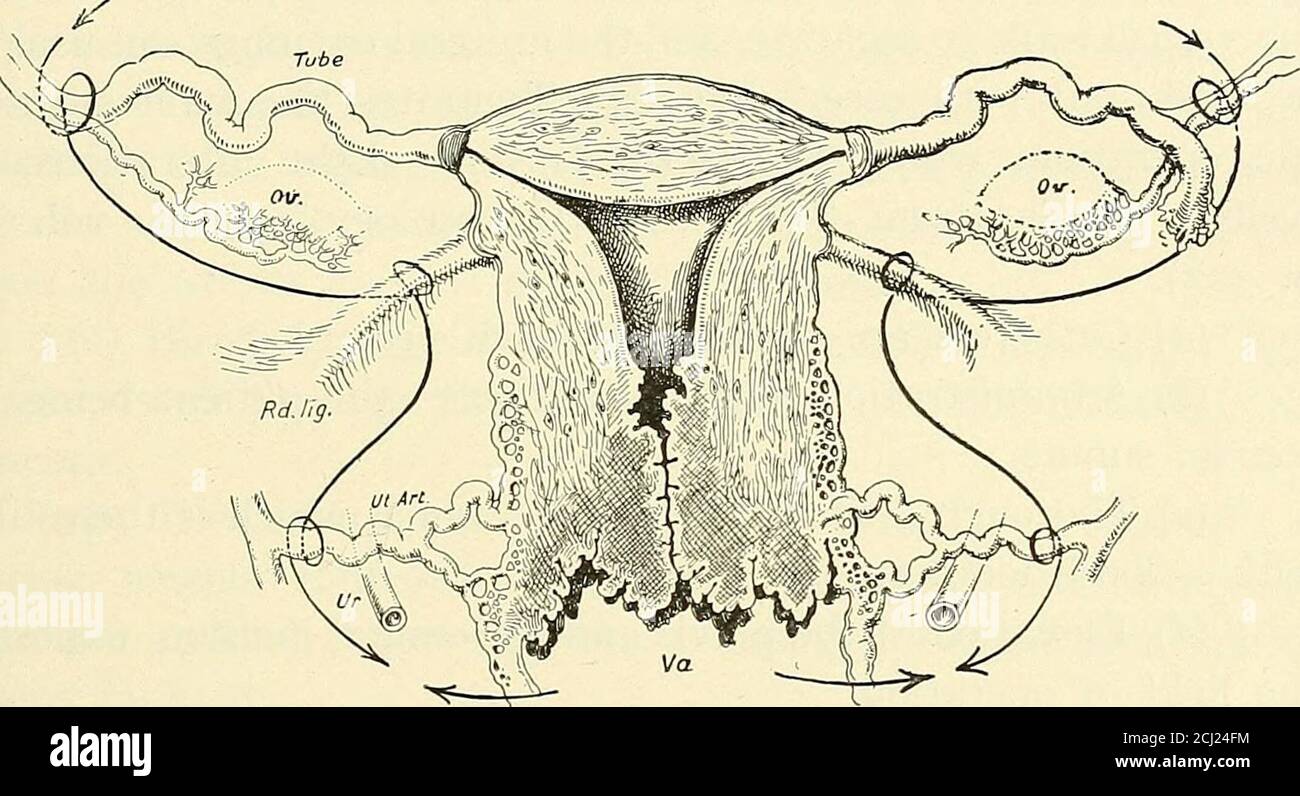 Rectal bleeding hi-res stock photography and images - Alamy