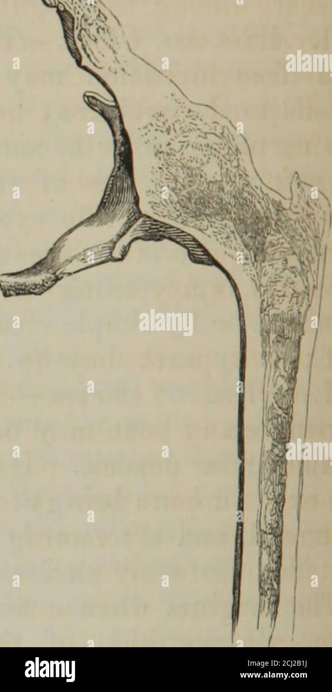 Amputation cause hi-res stock photography and images - Alamy
