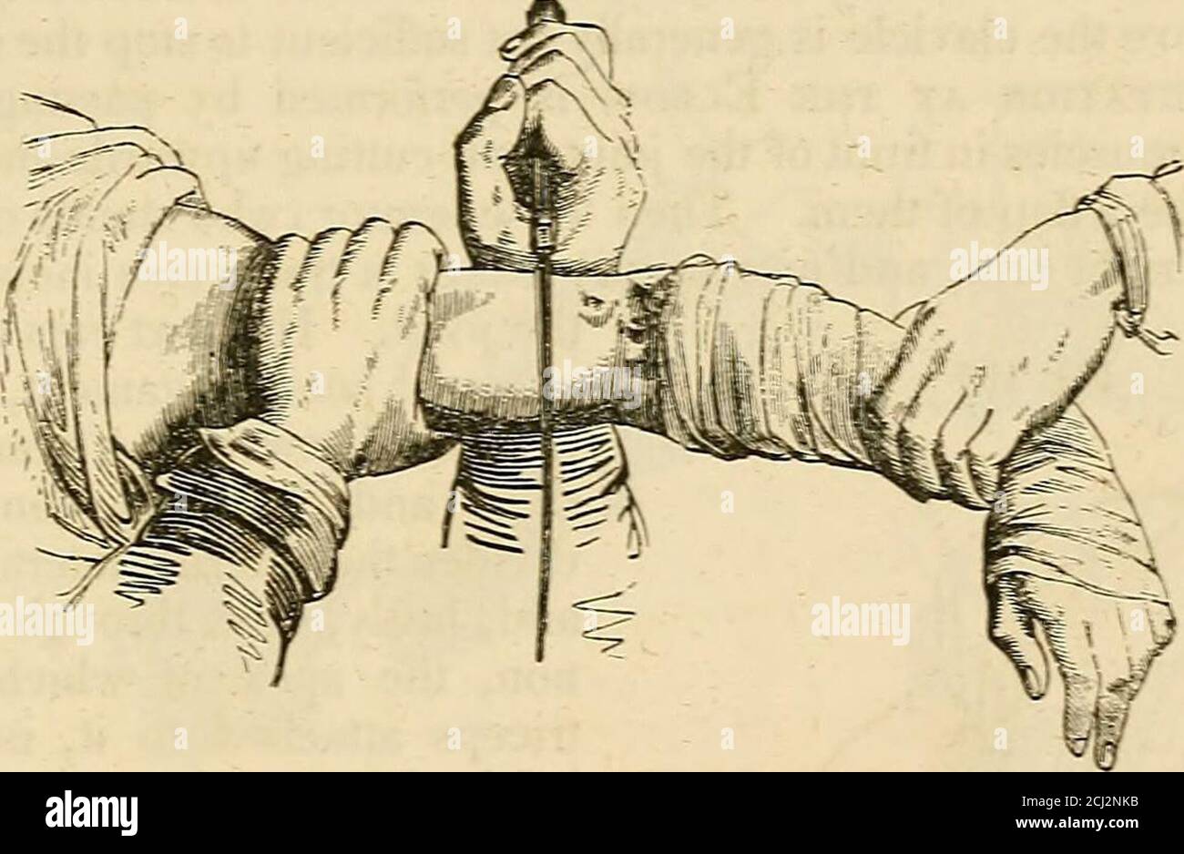 Incision made through the skin hi-res stock photography and images - Alamy