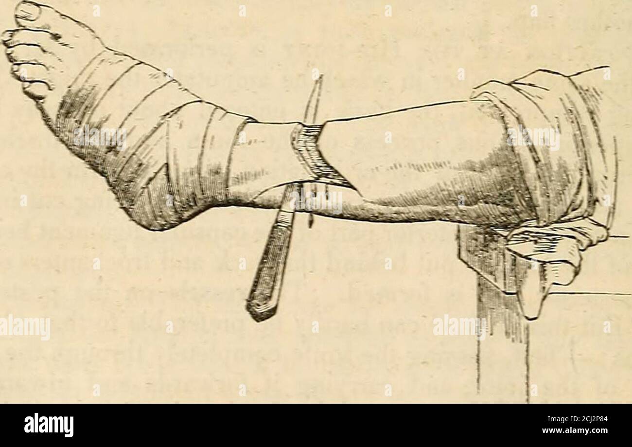 . The principles and practice of modern surgery . ner side for the ...