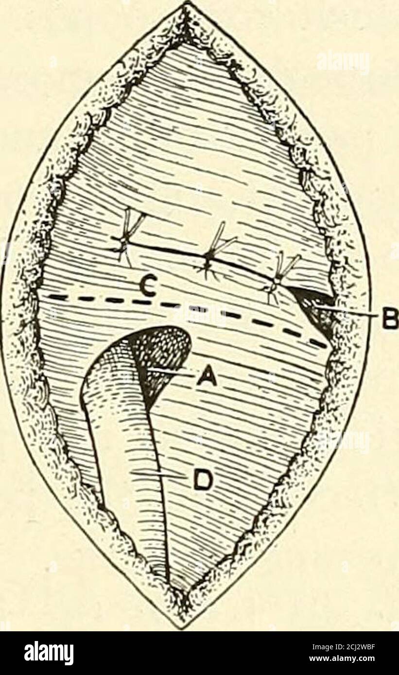 . A manual of operative surgery . fig. 106.—mr. battles method. [After ...