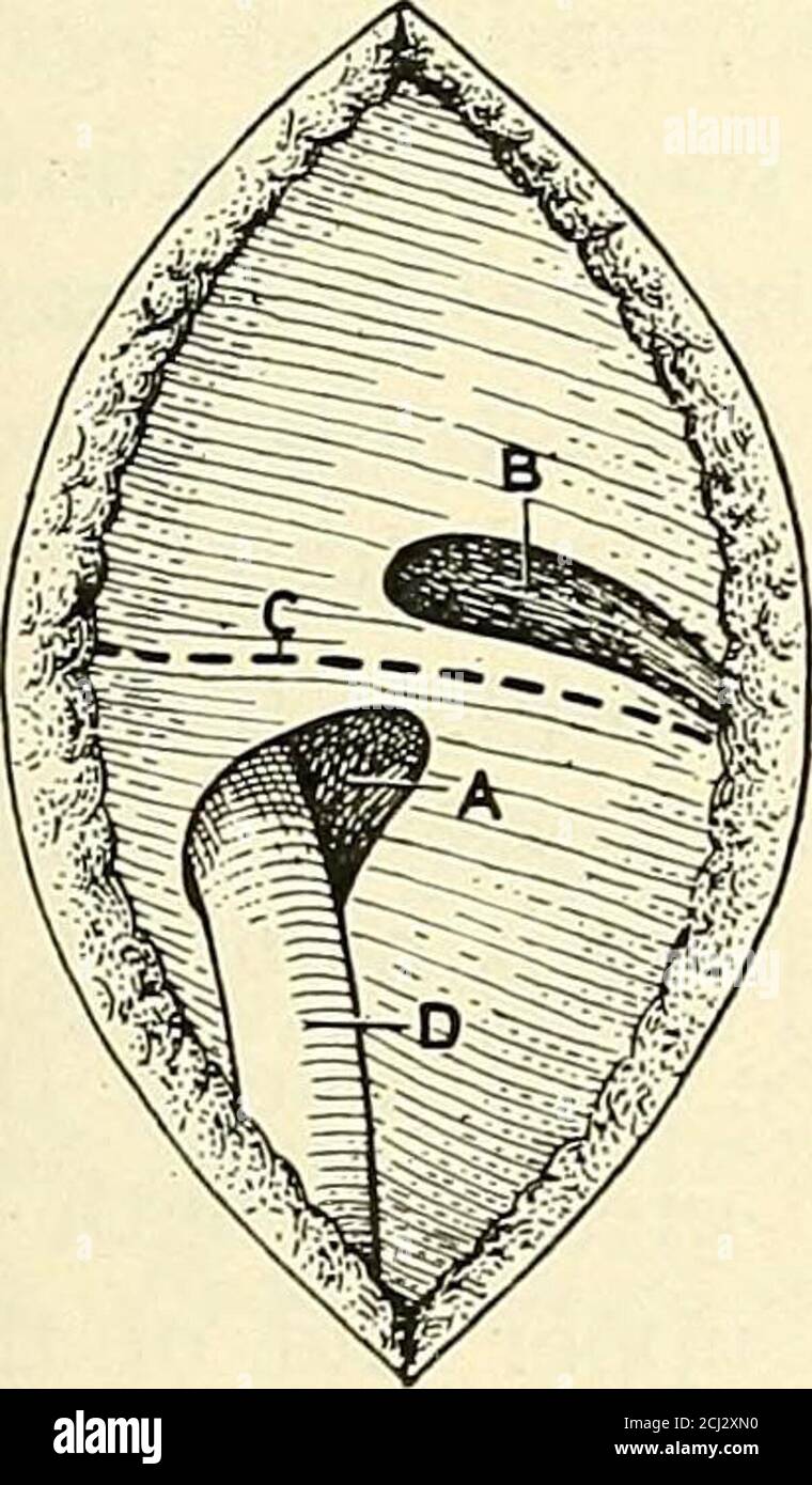 Pectineal line hi-res stock photography and images - Alamy