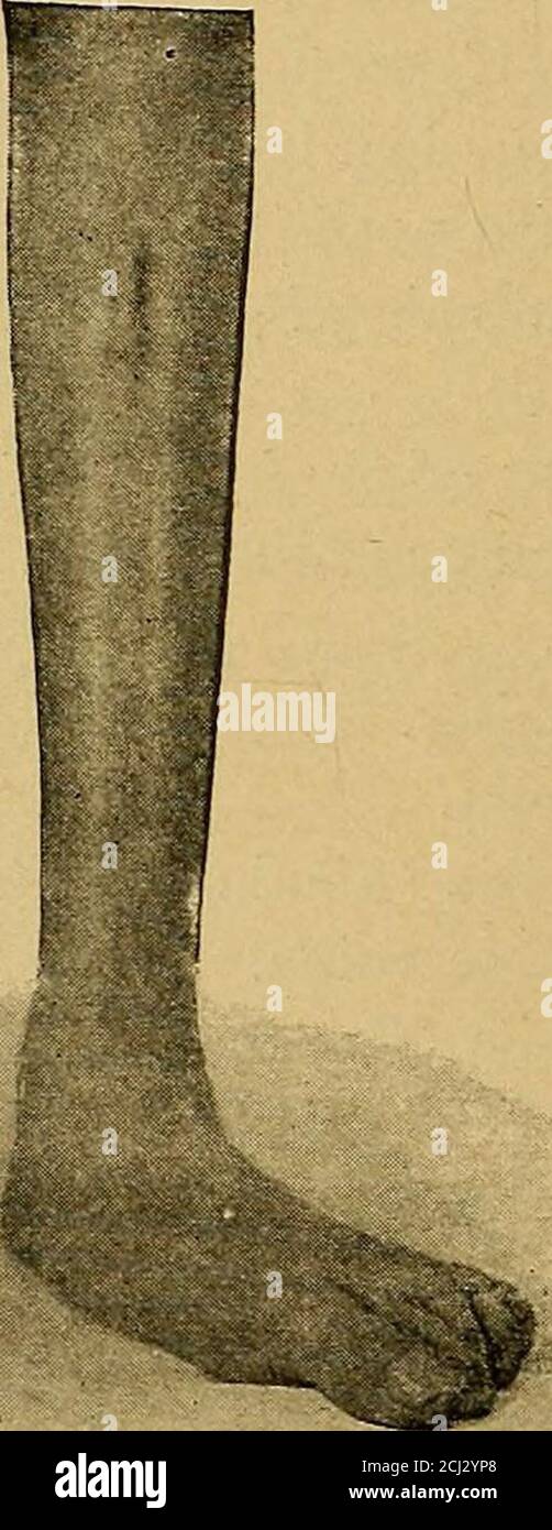 . Physical diagnosis . Fig. 306.—Flat-foot. (Bradford and Lovett.) 2 ...