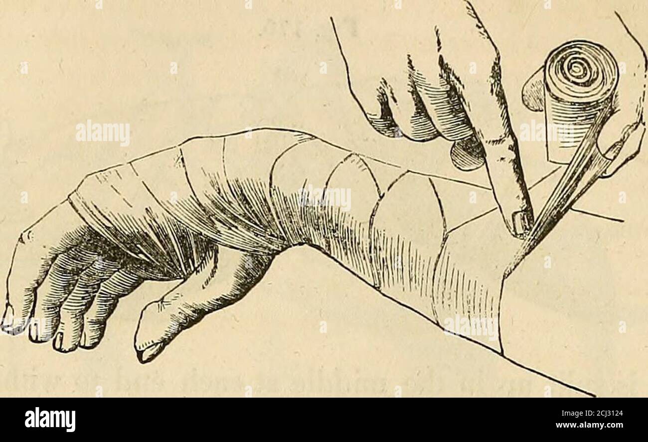 . The principles and practice of modern surgery . VI. For the Hand.—A ...