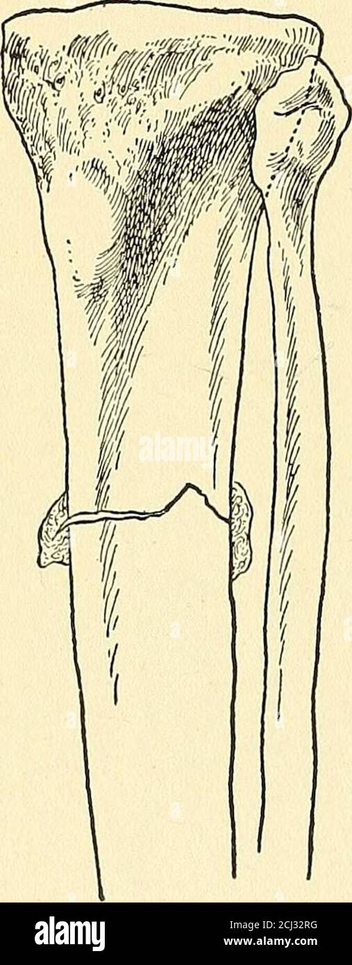 Fractured knee cap hi-res stock photography and images - Alamy