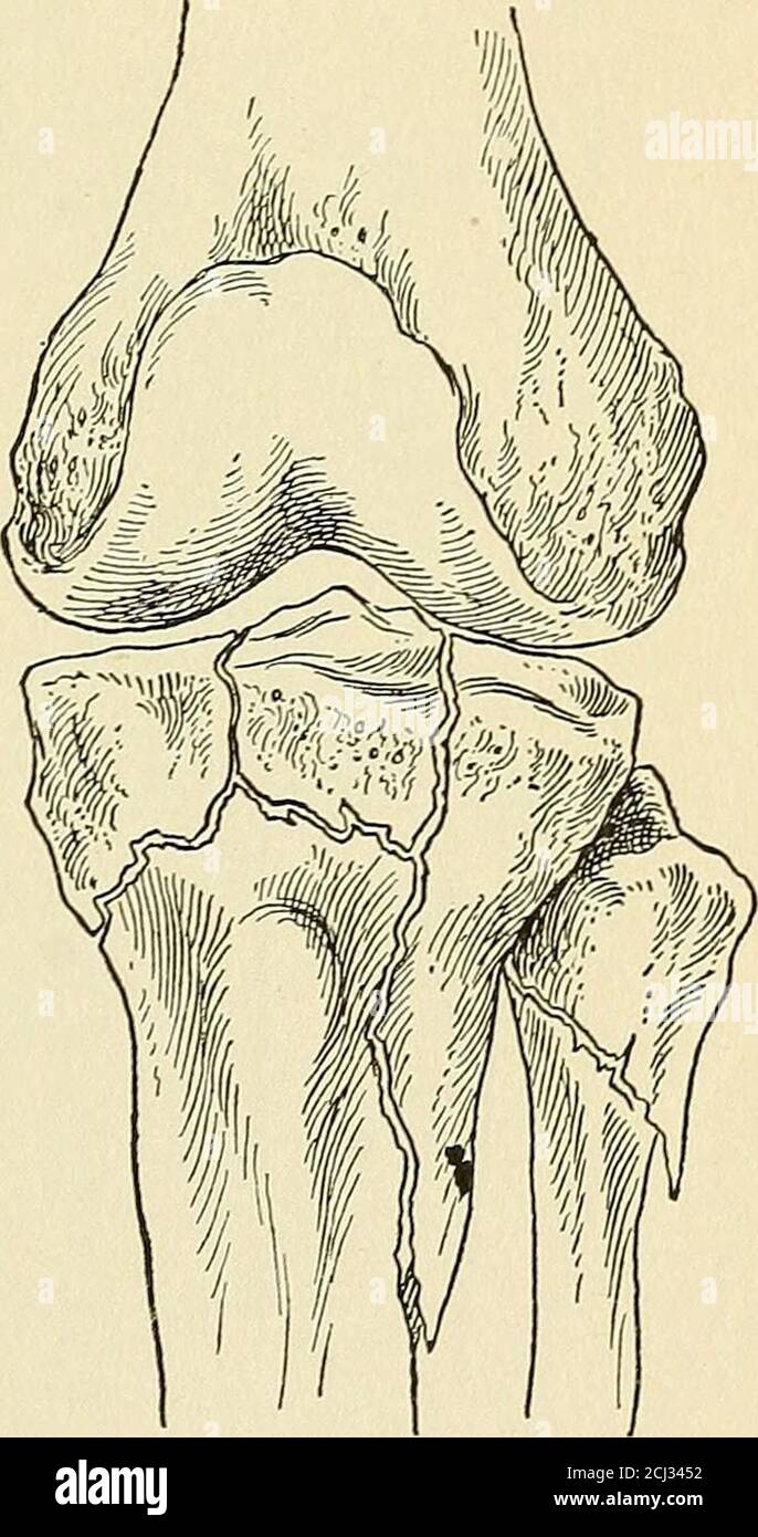 Fractures of the femur and tibia hi-res stock photography and images ...