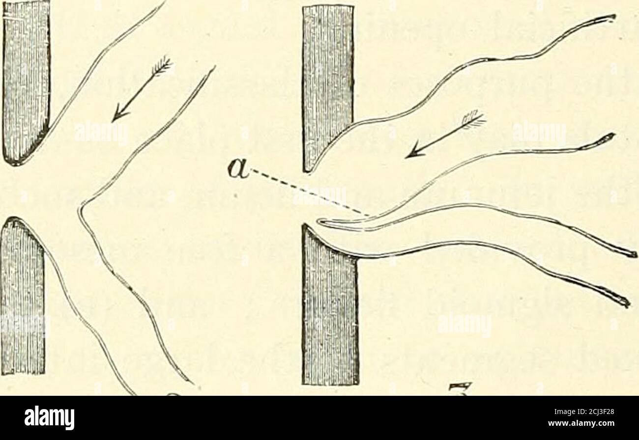 Bowel resection hi-res stock photography and images - Alamy
