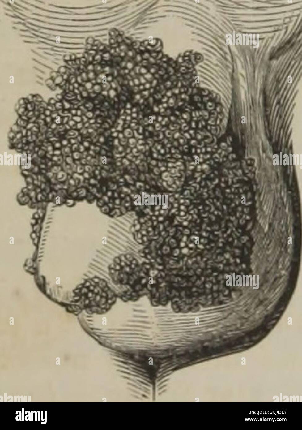 Areolar abscess hi-res stock photography and images - Alamy