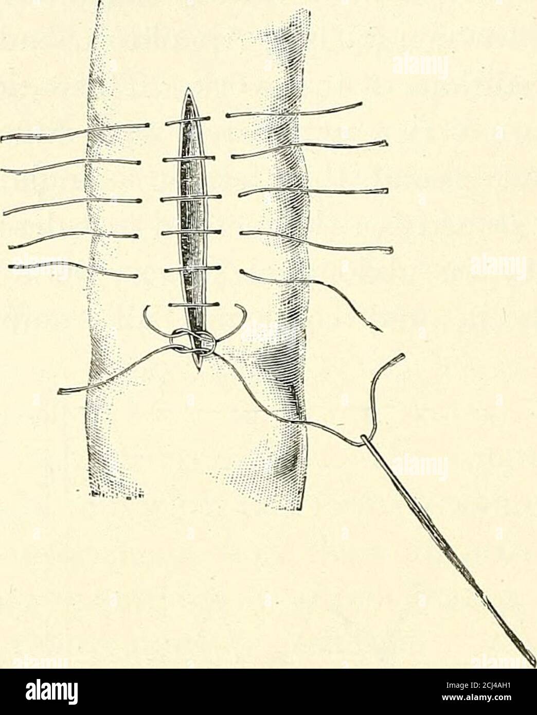 . A manual of operative surgery . mencement. After traversing a short ...