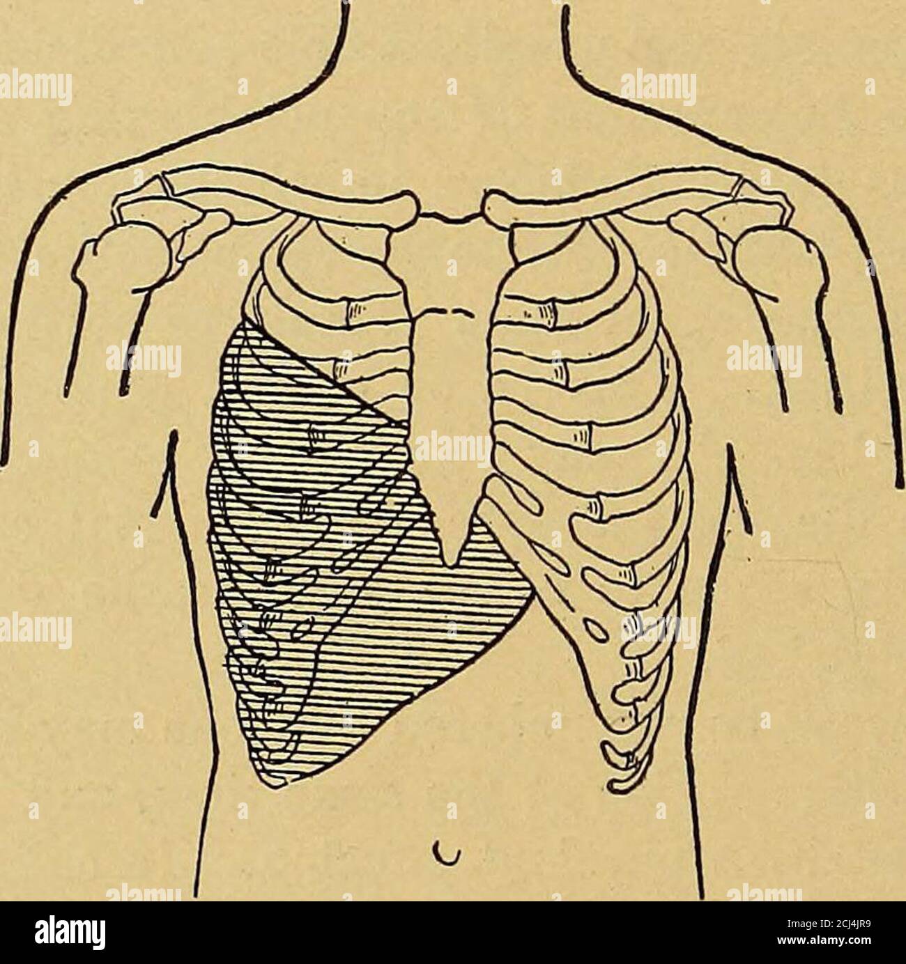 . Physical diagnosis . actile fremitus, andabsence of Littens ...