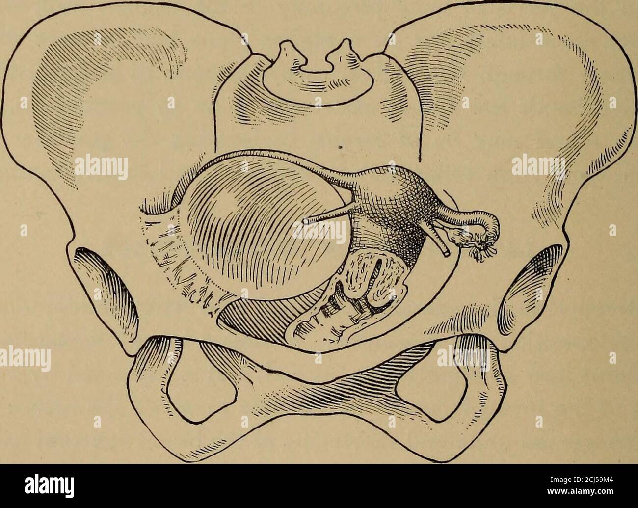 . The diagnosis of diseases of women . Left laterodisplacement of the ...