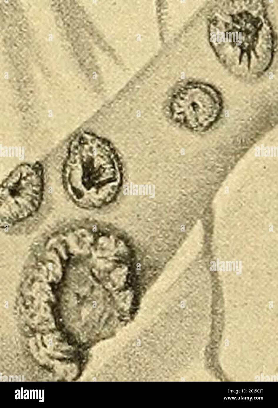 . Lehrbuch der Intoxikationen . Acne bromica vegetans (nach Kaposis ...