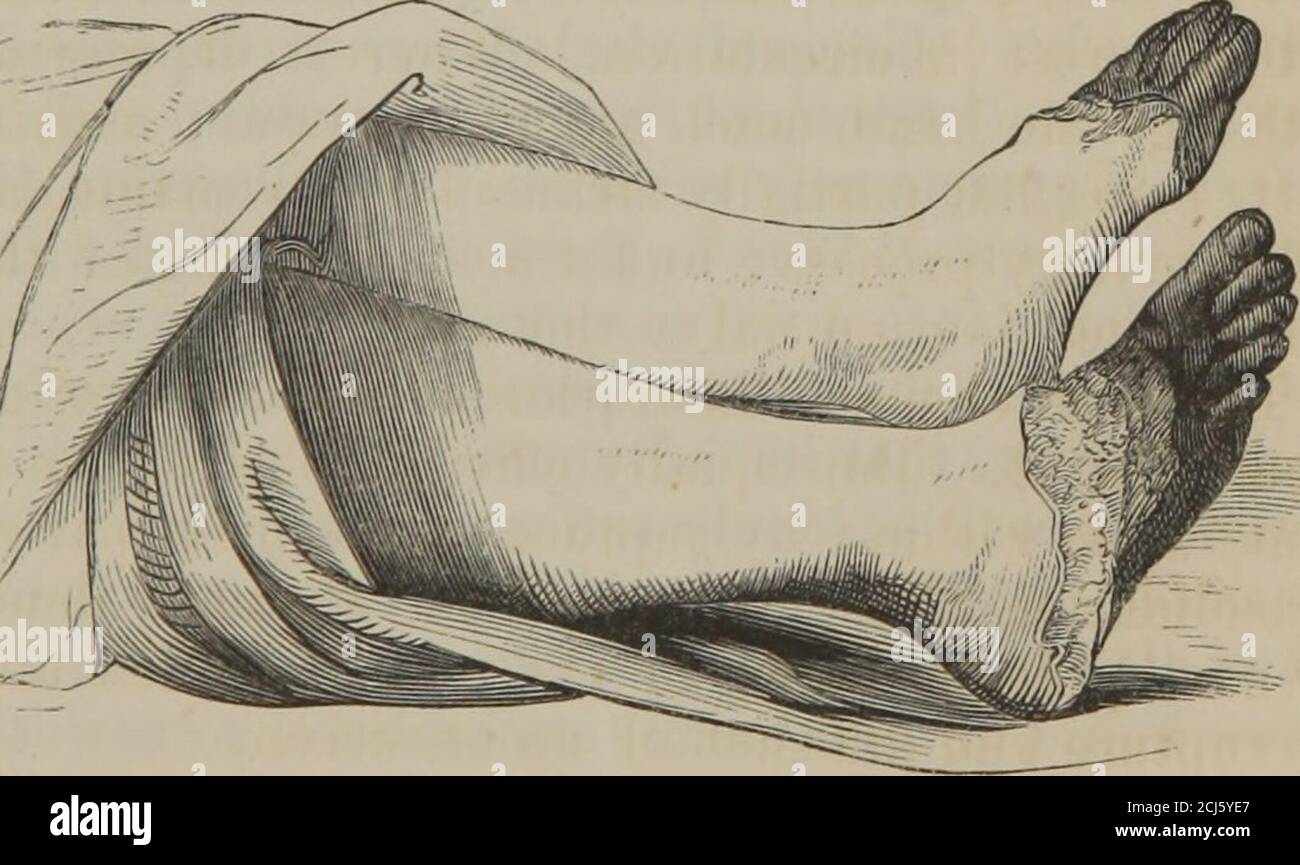 . The principles of surgery . ction; the blood rushing back to thepart ...