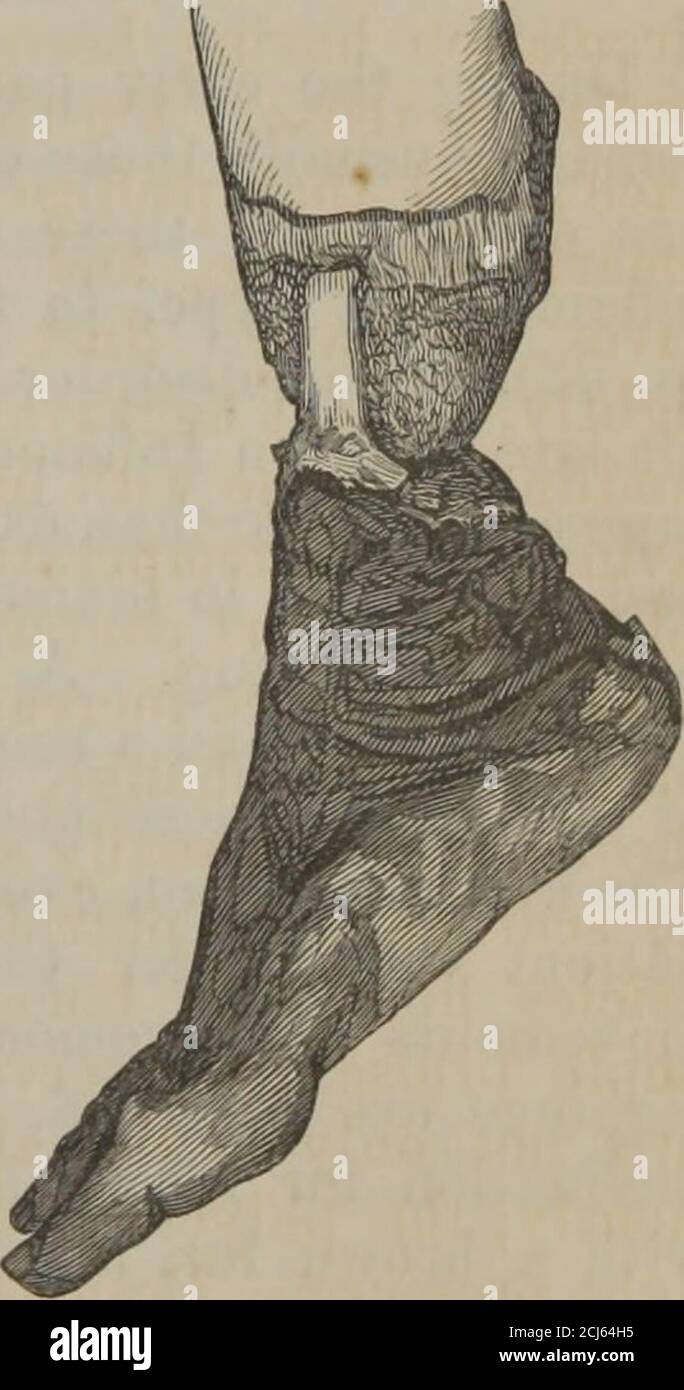 . The principles of surgery . e otherwise loose tissues from purulent ...
