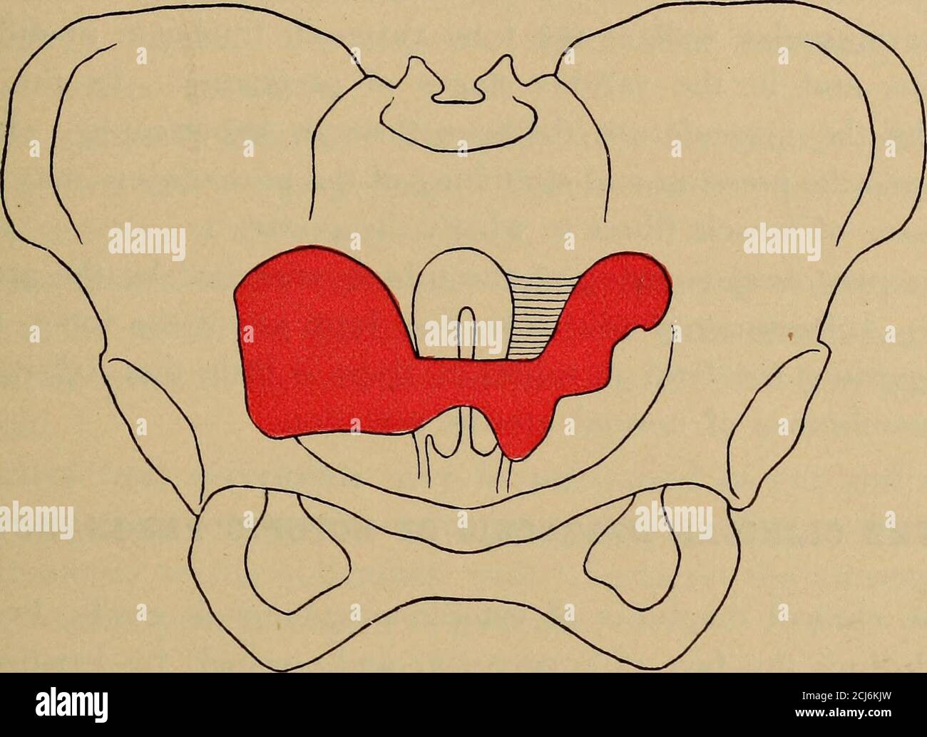 . The diagnosis of diseases of women . Hsematoma of the left broad ...
