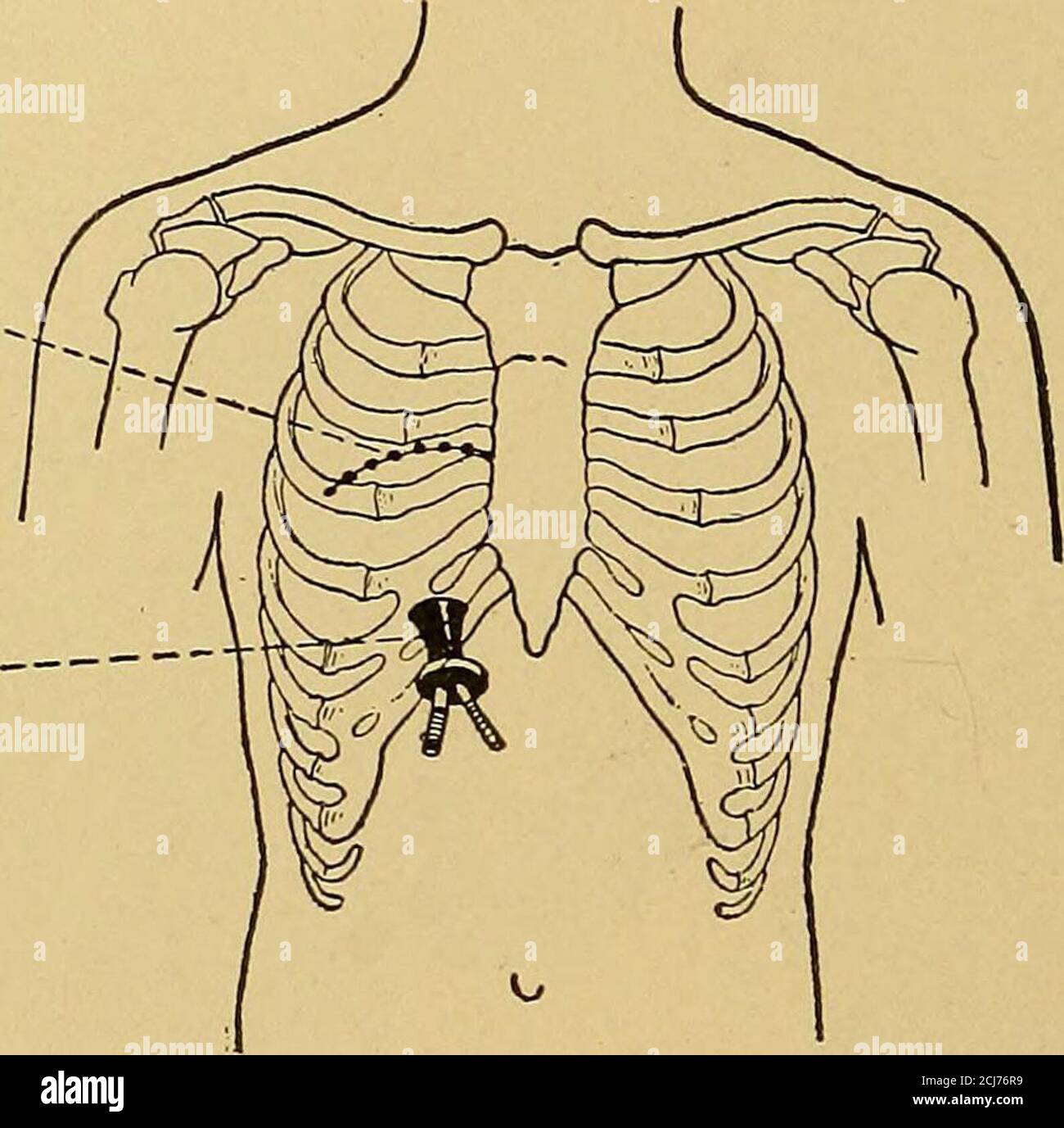 . Physical diagnosis . ed as a pleximeter in the ordinary way. Some ...