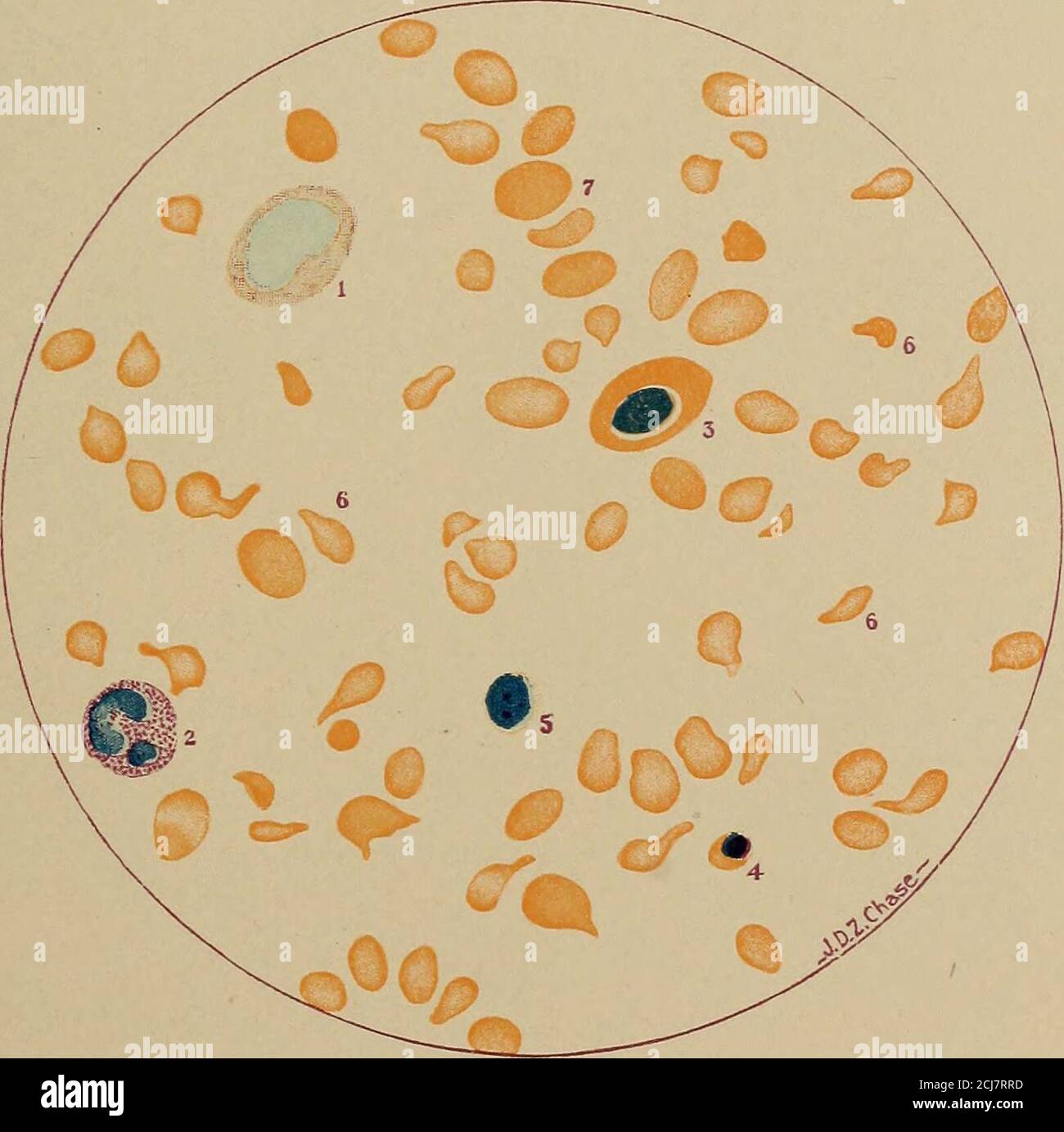 Polymorphonuclear leukocyte hi-res stock photography and images - Alamy