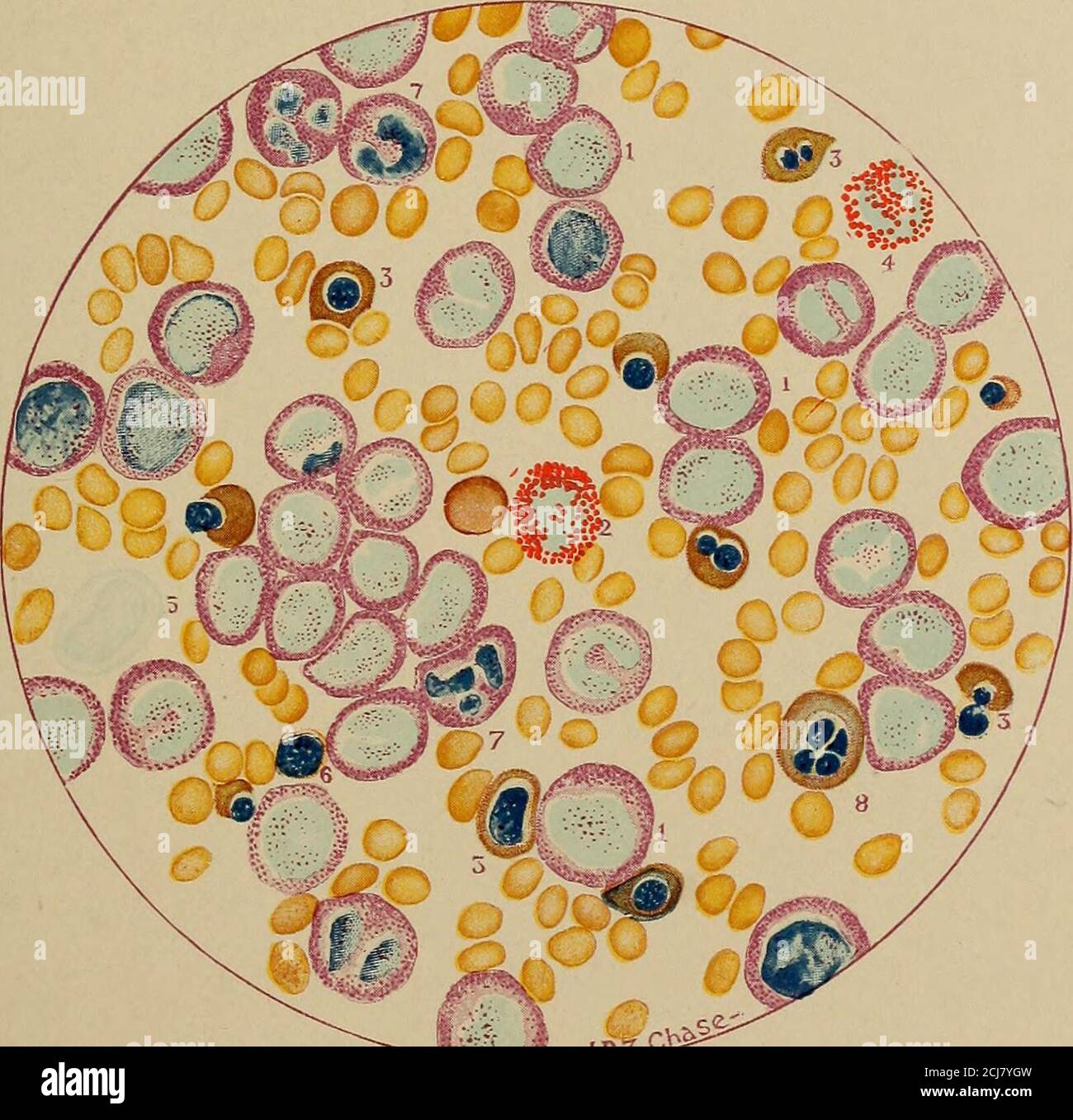. The diagnosis of diseases of women . Lymphatic Leukaemia. Large ...