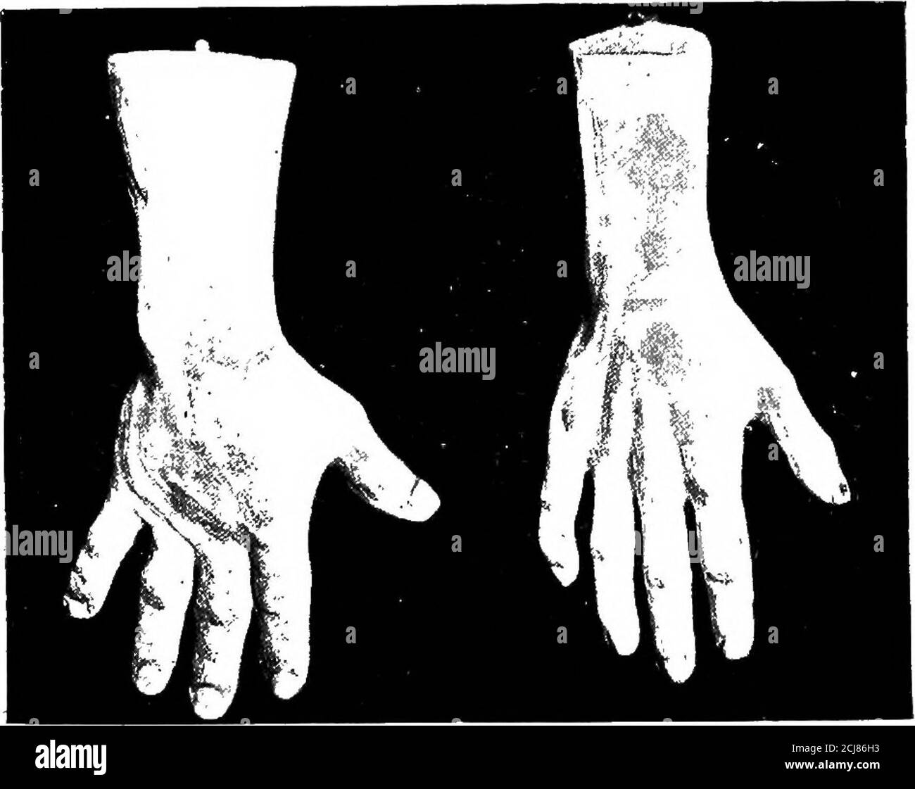 Enlarged knuckles Black and White Stock Photos & Images - Alamy