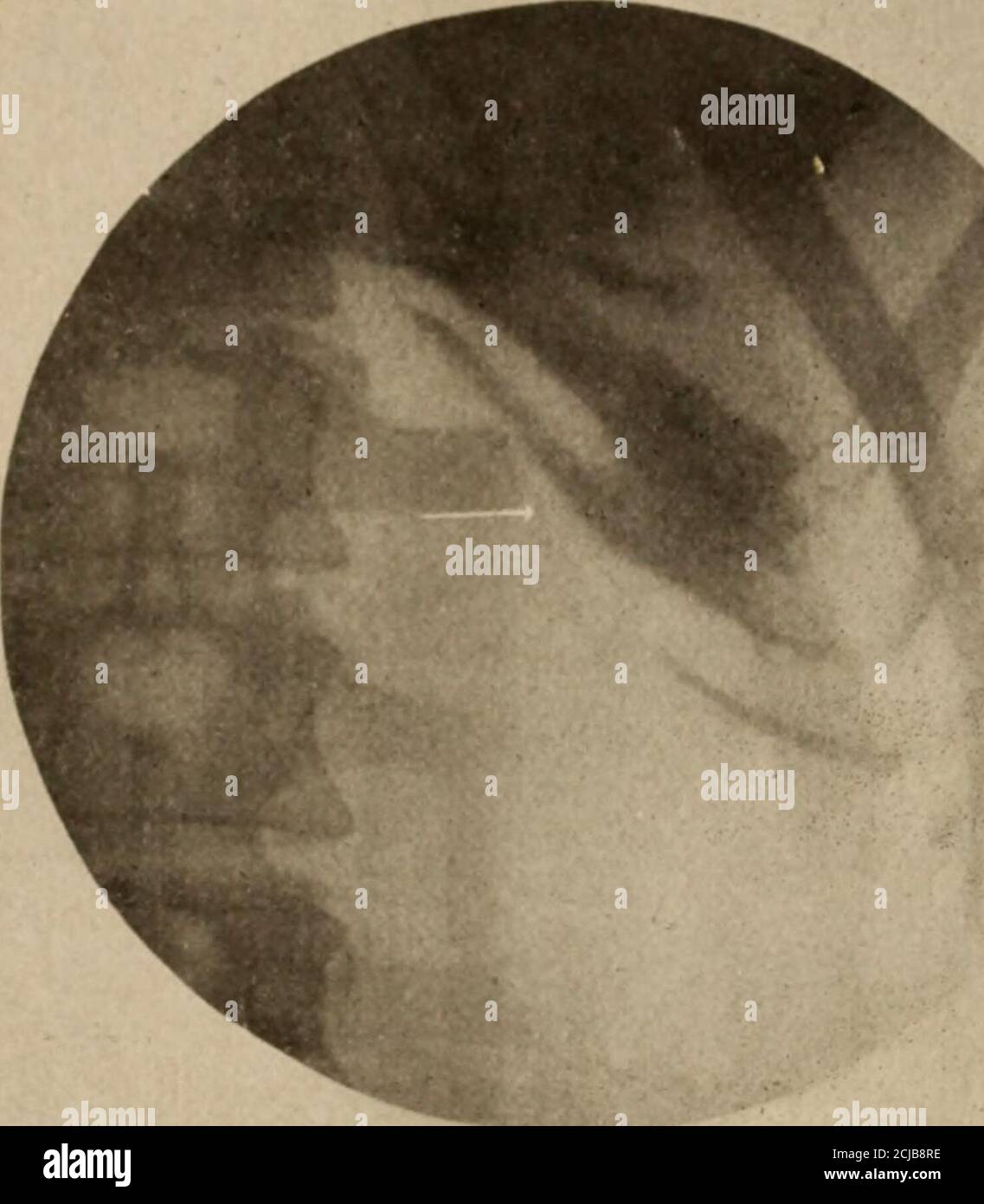. Buffalo medical journal . Fig. 5.—1. Mass of nearly forty small gall ...