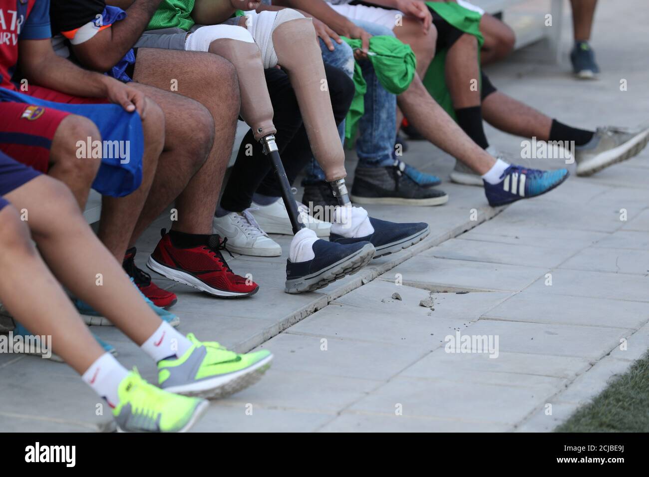 Congenital amputation hi-res stock photography and images - Alamy