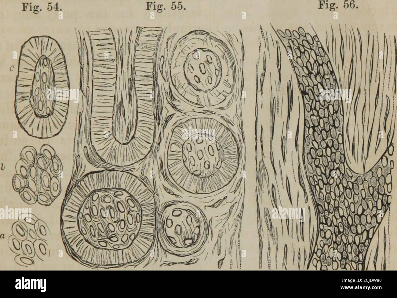 Vascular tumour hi-res stock photography and images - Alamy