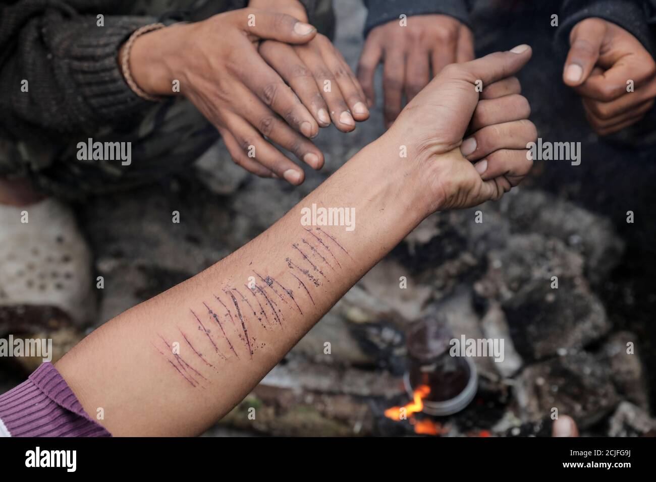 Scars Arm High Resolution Stock Photography and Images - Alamy
