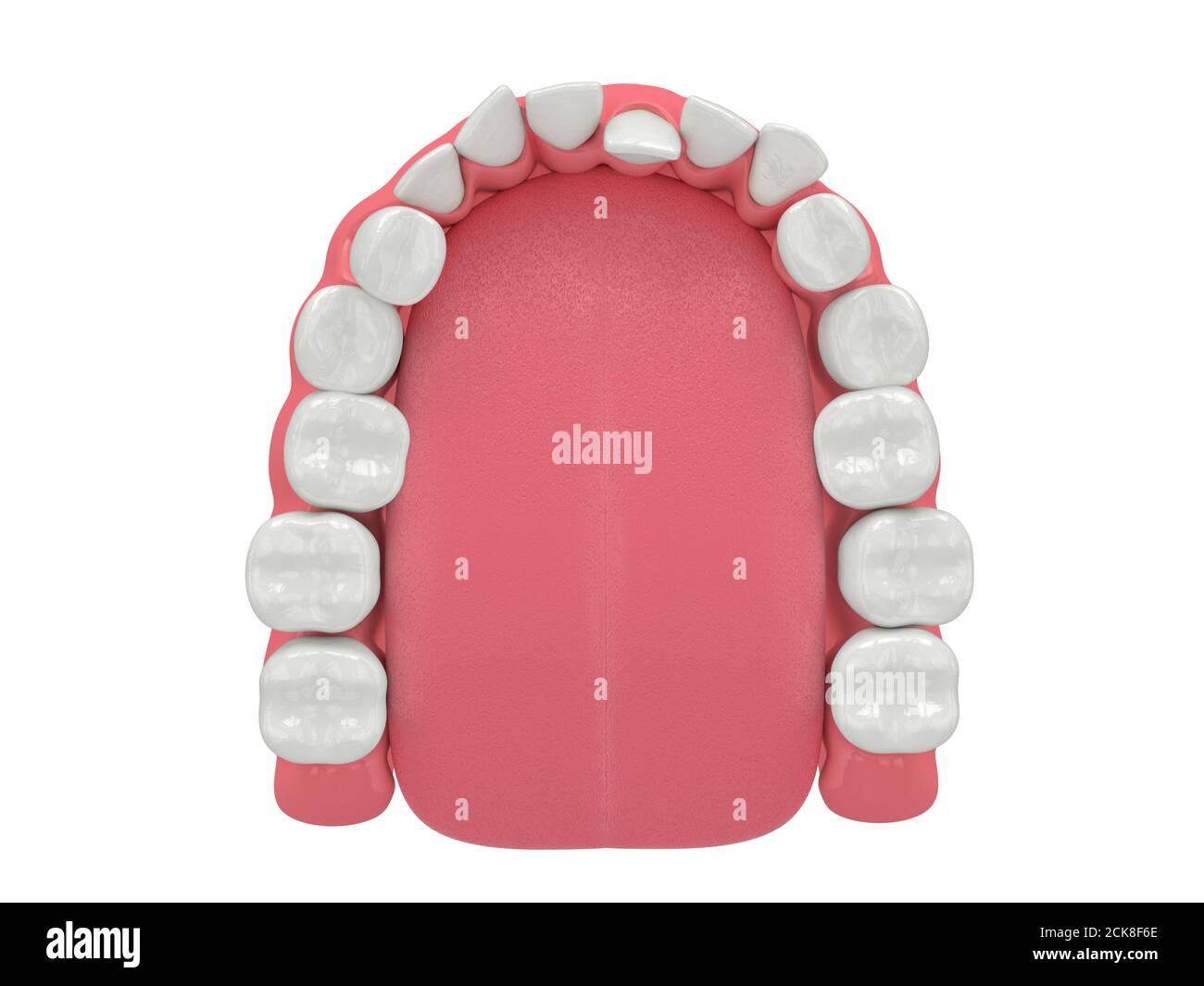3d render of jaw with abnormal teeth position. Orthodontic treatment ...