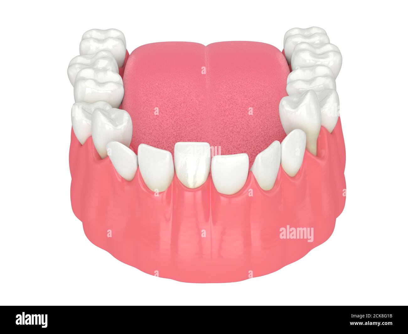 3d render of jaw with abnormal teeth position. Orthodontic treatment ...